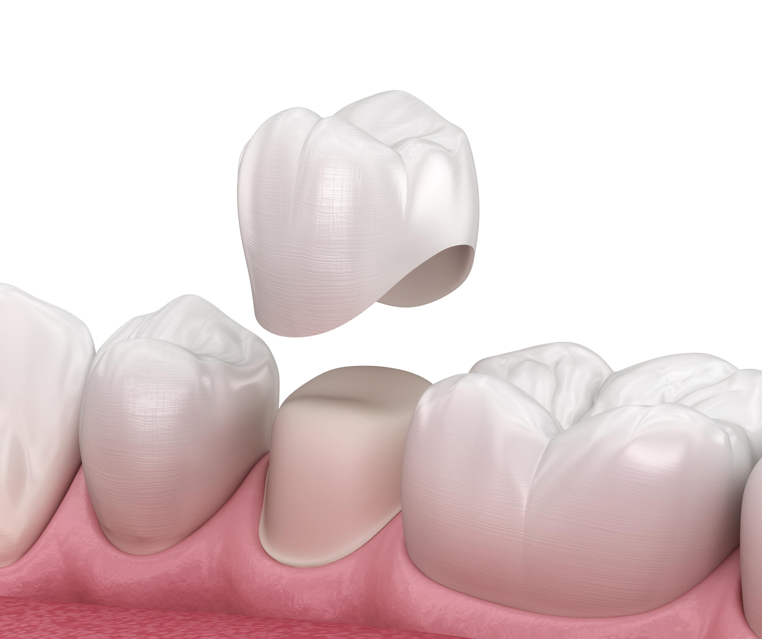 Understanding Dental Crowns: Types, Benefits, and Costs